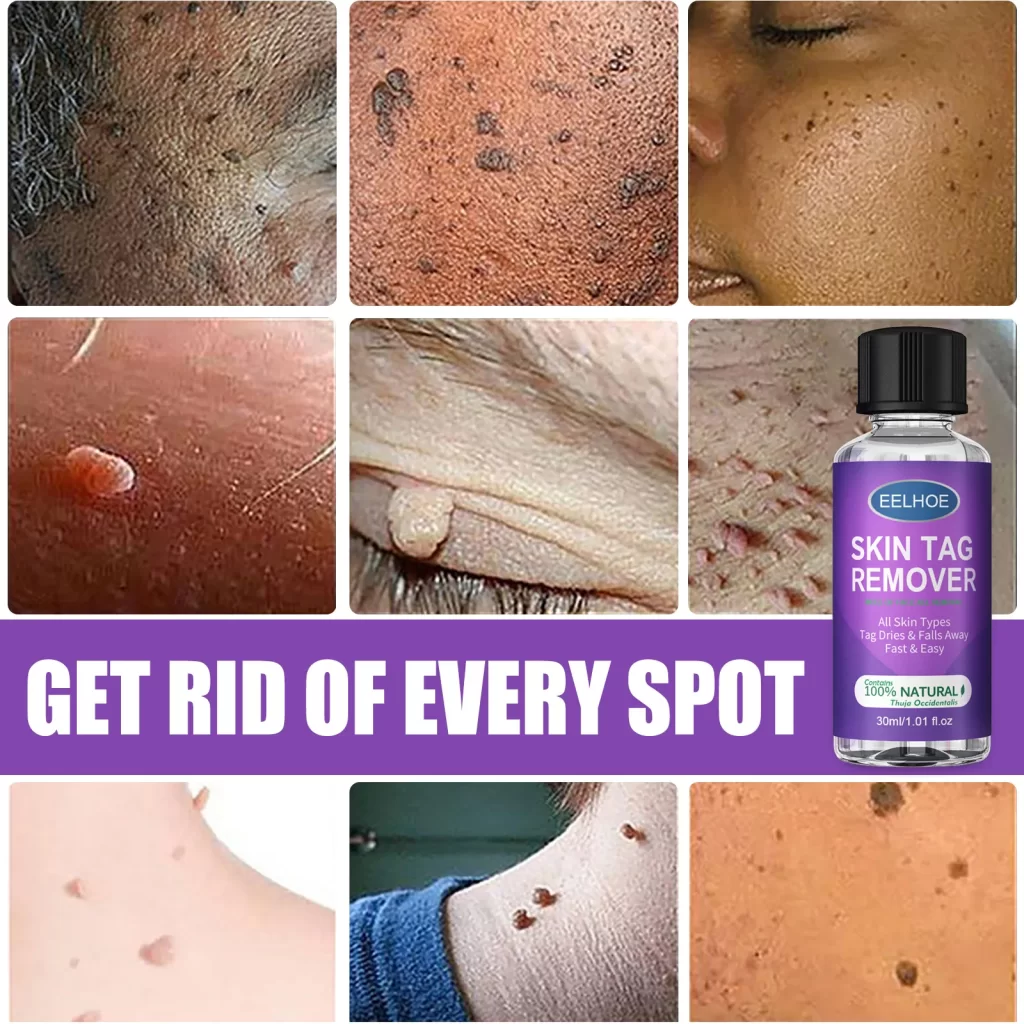 skintag-remover – fortemart